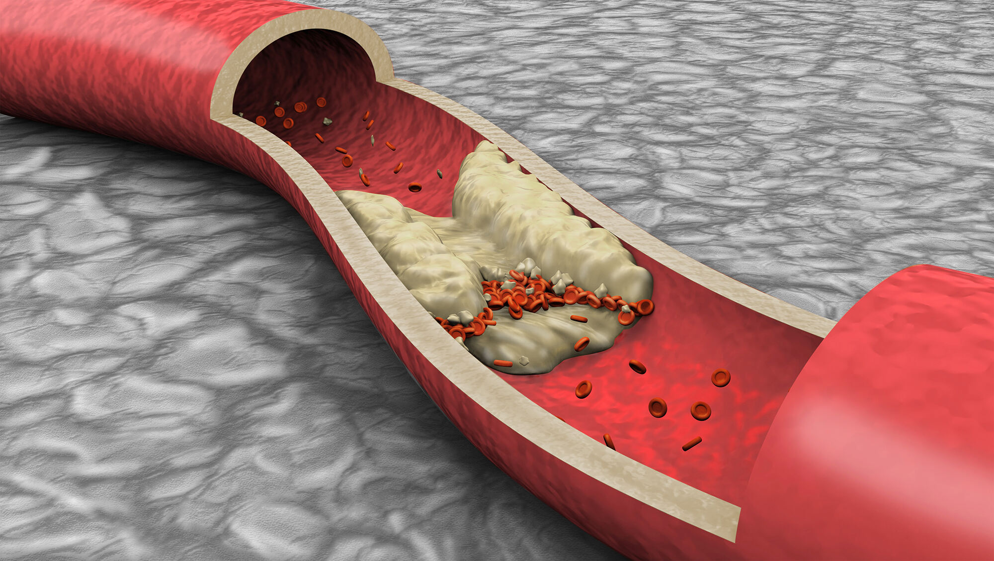 Streptokinase Indication
